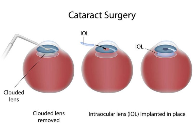 cataract-surgery-chart | Prairie Eye Center